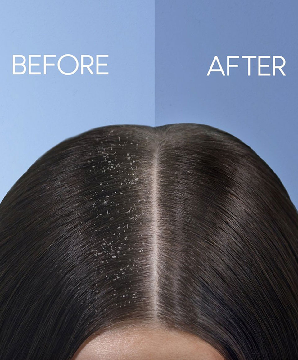 anti dandruff shampoo | Head And Shoulders Daily Protect Anti Microbial ...